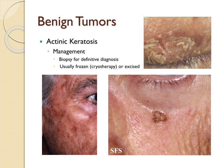 PPT - Eyelid Lumps and Bumps PowerPoint Presentation - ID:318536