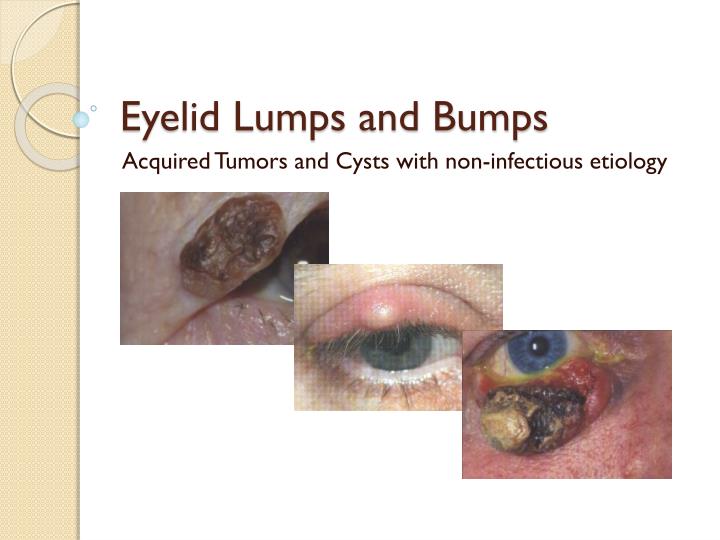 PPT - Eyelid Lumps and Bumps PowerPoint Presentation, free download ...