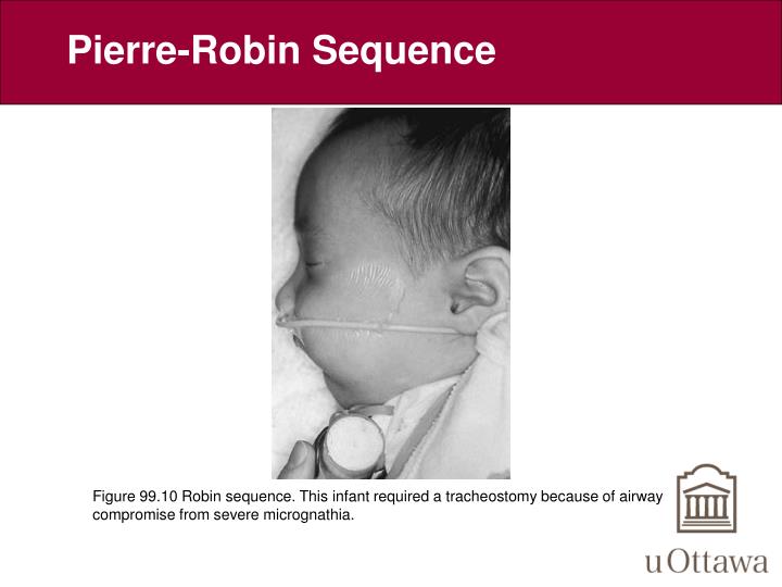 PPT - A Review of Pediatric Syndromes PowerPoint Presentation - ID:319350