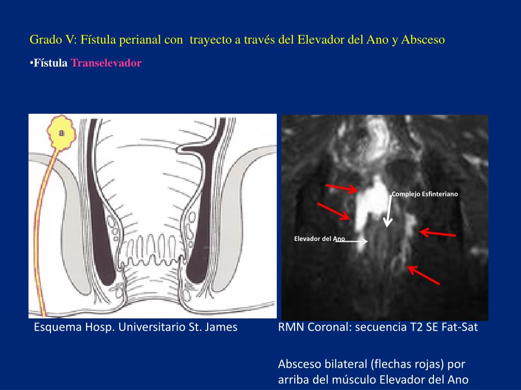 PPT - Fístula Perianal . Hallazgos en Resonancia Magnética Nuclear con ...