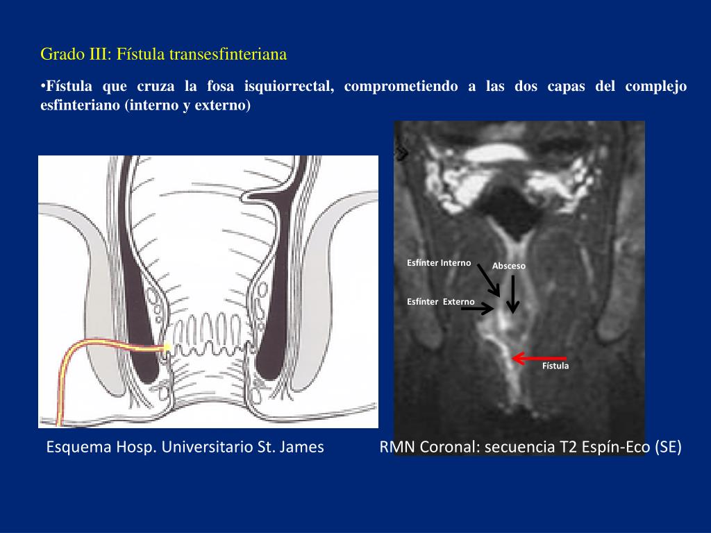 PPT - Fístula Perianal . Hallazgos en Resonancia Magnética Nuclear con ...