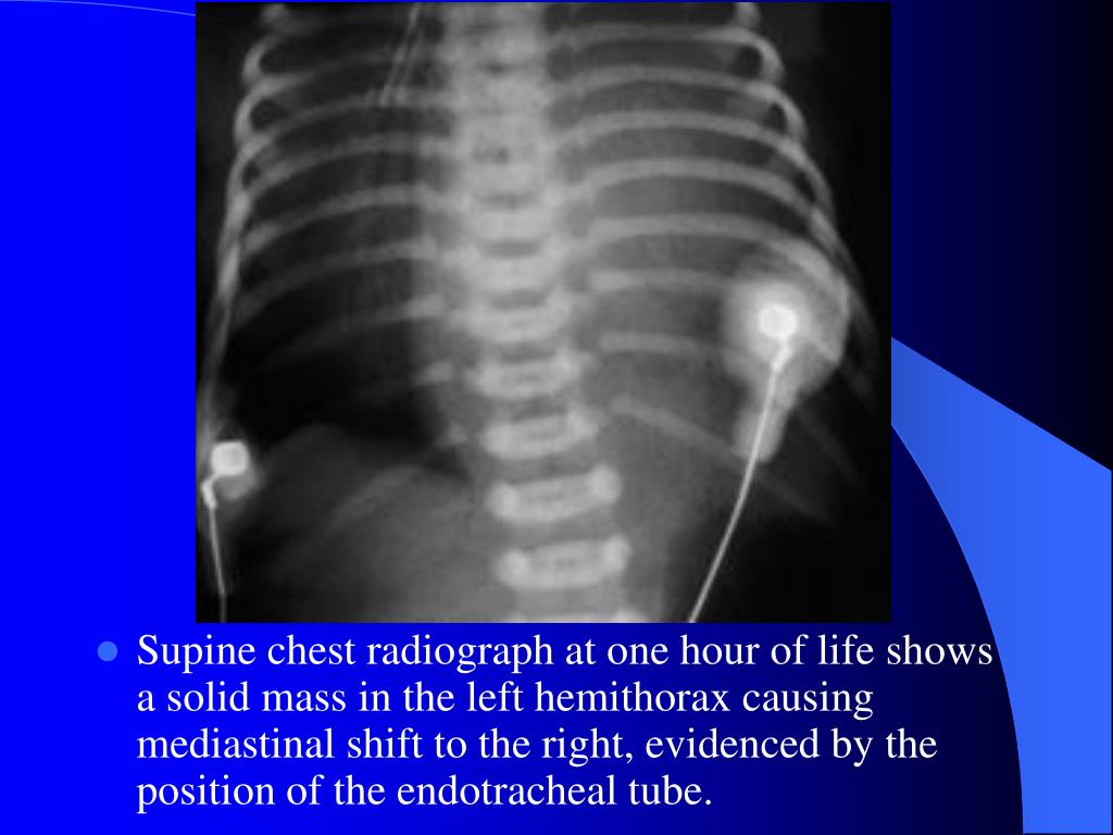 PPT - Congenital Cystic Adenomatoid Malformation (CCAM) of the Lung ...