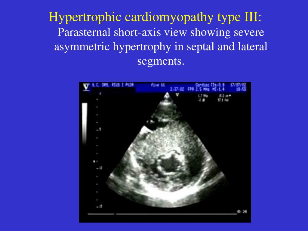 PPT - Miocardiopatia Hipertrófica PowerPoint Presentation, free ...