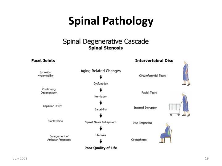 PPT - X STOP ™ Interspinous Process Decompression (IPD ® ) System ...