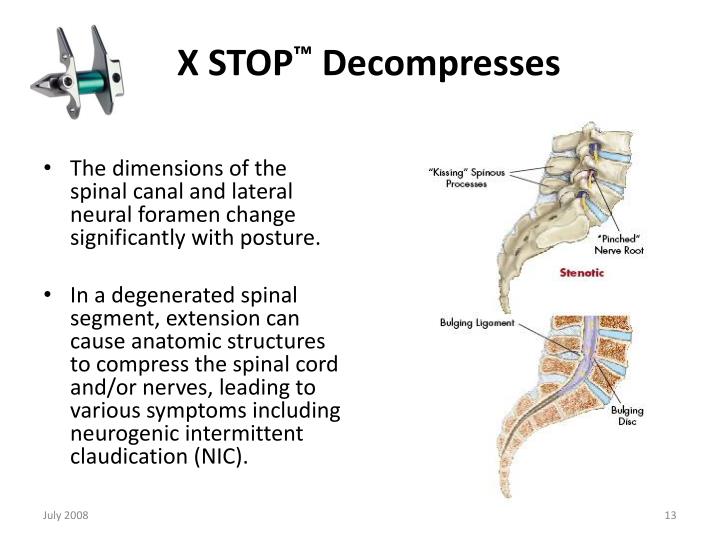 PPT - X STOP ™ Interspinous Process Decompression (IPD ® ) System ...