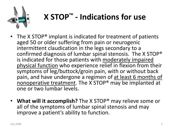 PPT - X STOP ™ Interspinous Process Decompression (IPD ® ) System ...
