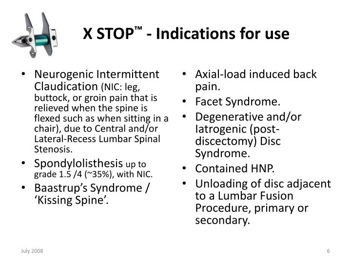 PPT - X STOP ™ Interspinous Process Decompression (IPD ® ) System ...