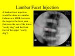 PPT - Flouro Images of Lumbar Spine Injections PowerPoint Presentation ...