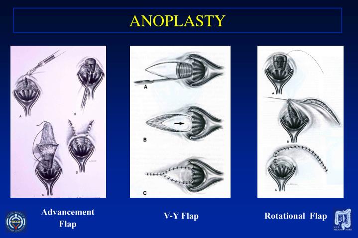 PPT - TREATMENT OF ANAL FISSURES PowerPoint Presentation - ID:332663