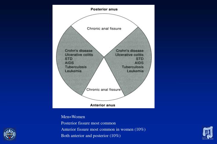 Ppt Treatment Of Anal Fissures Powerpoint Presentation Id332663