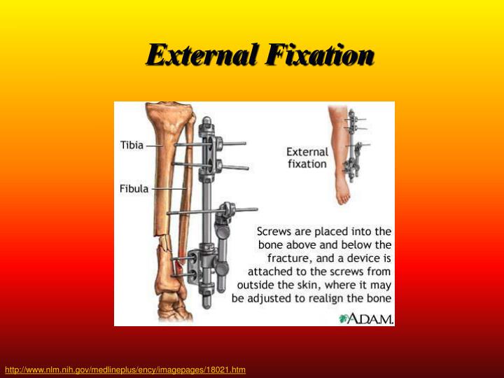 PPT - Fracture Fixation Internal & External PowerPoint Presentation ...