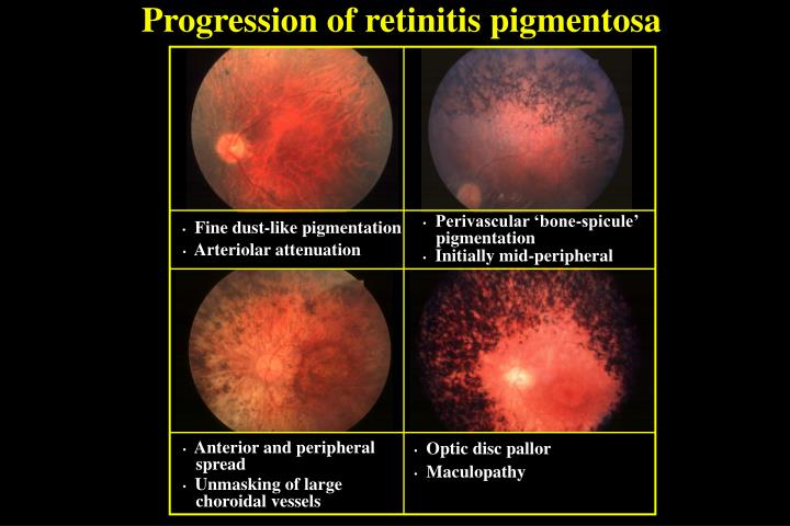 PPT - HEREDITARY RETINAL DYSTROPHIES PowerPoint Presentation - ID:335032