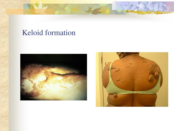 PPT - Integumentary: Burns PowerPoint Presentation - ID:337965