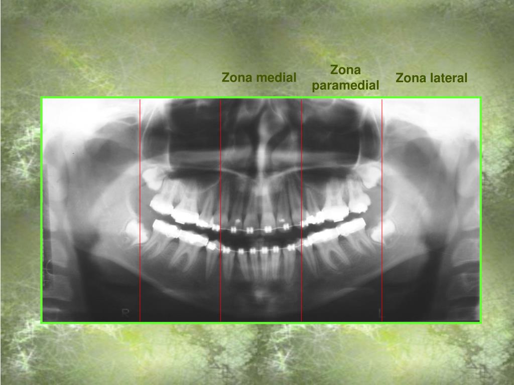 PPT - Estructuras Anatómicas en Radiografías Panorámicas PowerPoint ...