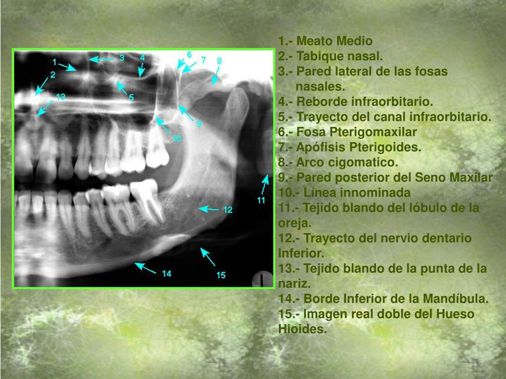 PPT - Estructuras Anatómicas en Radiografías Panorámicas PowerPoint ...