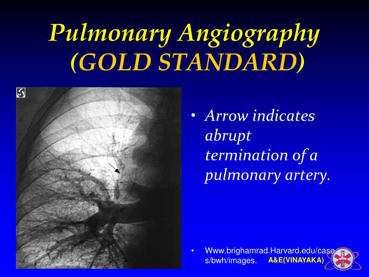PPT - APPROACH TO CHEST PAIN PowerPoint Presentation - ID:347743