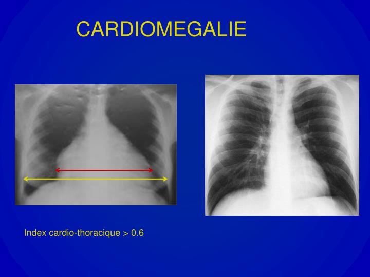 PPT - INSUFFISANCE CARDIAQUE ET VALVULOPATHIES PowerPoint Presentation ...