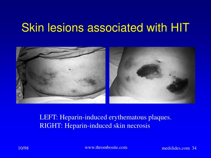 PPT - Heparin-Induced Thrombocytopenia PowerPoint Presentation - ID:352104