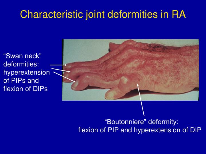 PPT - Rheumatoid Arthritis PowerPoint Presentation - ID:352806