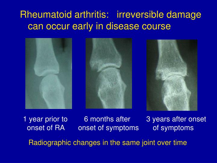 PPT - Rheumatoid Arthritis PowerPoint Presentation - ID:352806