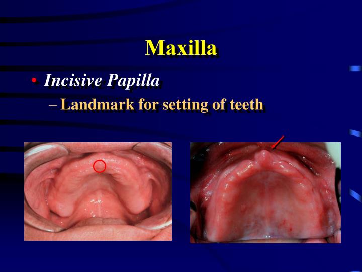 PPT - Anatomy for Complete and Partial Dentures PowerPoint Presentation ...