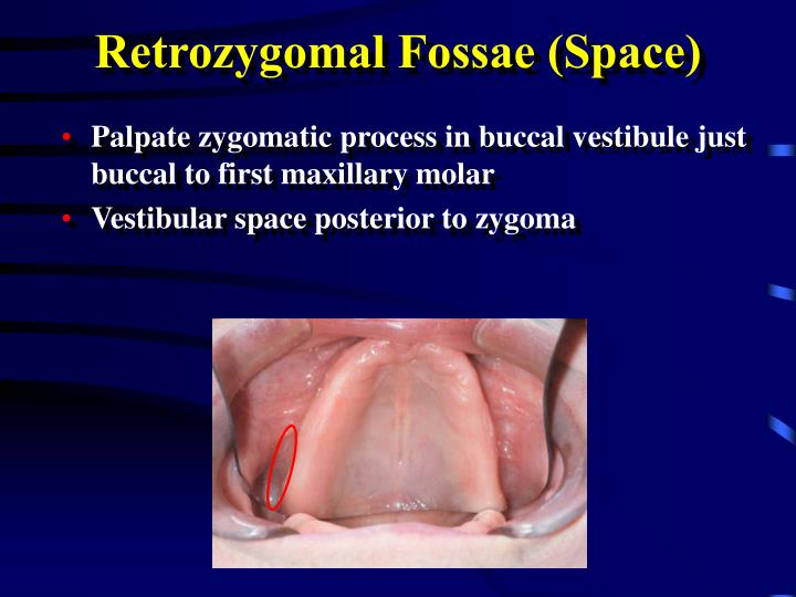 PPT - Anatomy for Complete and Partial Dentures PowerPoint Presentation ...