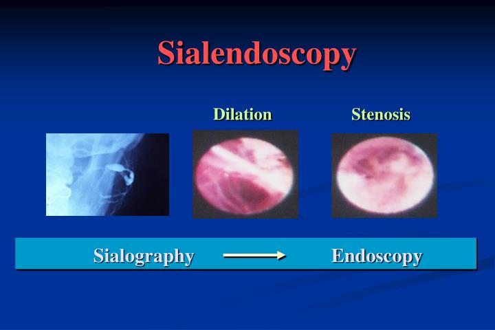 PPT - Chronic Obstructive Sialadenitis & Sialendoscopy PowerPoint Presentation - ID:358578