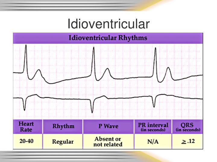 PPT - Rhythm & 12 Lead EKG Review PowerPoint Presentation - ID:359042