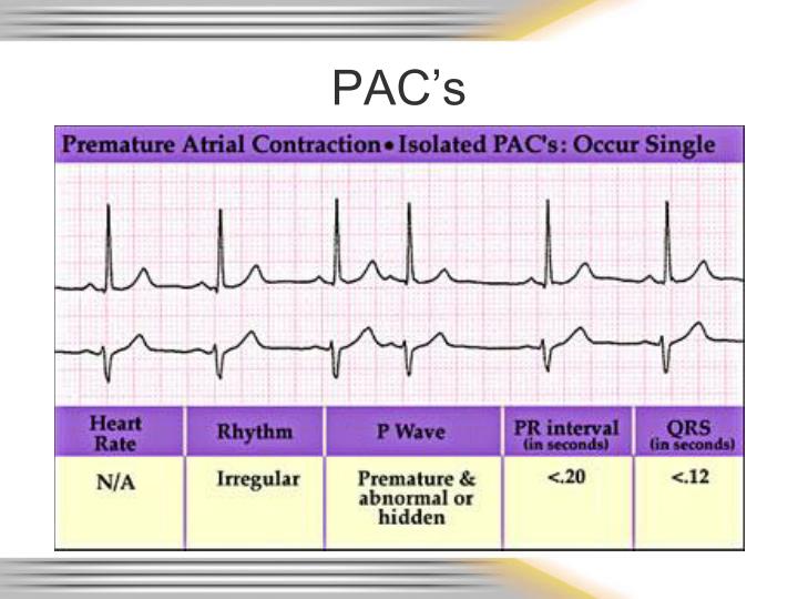 PPT - Rhythm & 12 Lead EKG Review PowerPoint Presentation - ID:359042