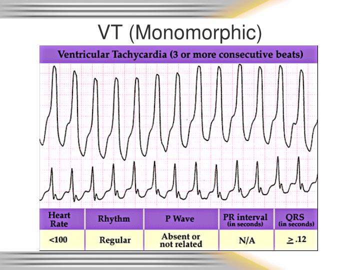 PPT - Rhythm & 12 Lead EKG Review PowerPoint Presentation - ID:359042