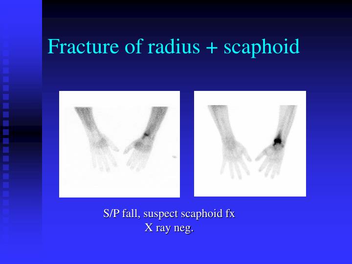 PPT - Nuclear Medicine in the Evaluation of Trauma PowerPoint ...