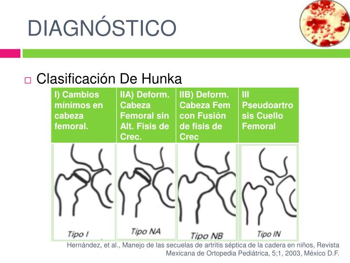 PPT - Osteomielitis y artritis séptica PowerPoint Presentation - ID:362107