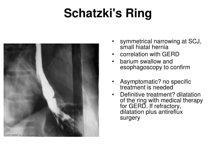 PPT - GERD/Barrett's Esophagus, Dysphagia, Hiatal Hernia, and ...
