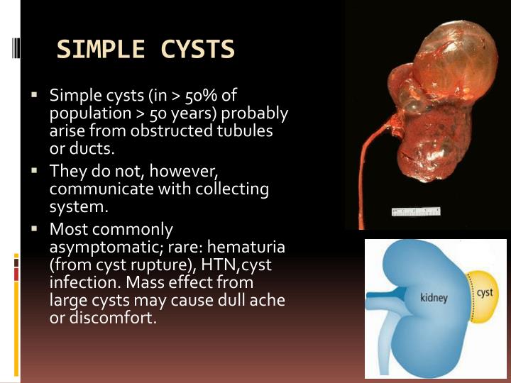 PPT - Simple and Complex renal Cysts PowerPoint Presentation - ID:363278