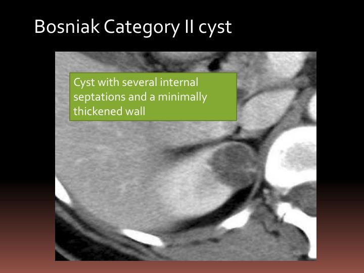 PPT - Simple and Complex renal Cysts PowerPoint Presentation - ID:363278