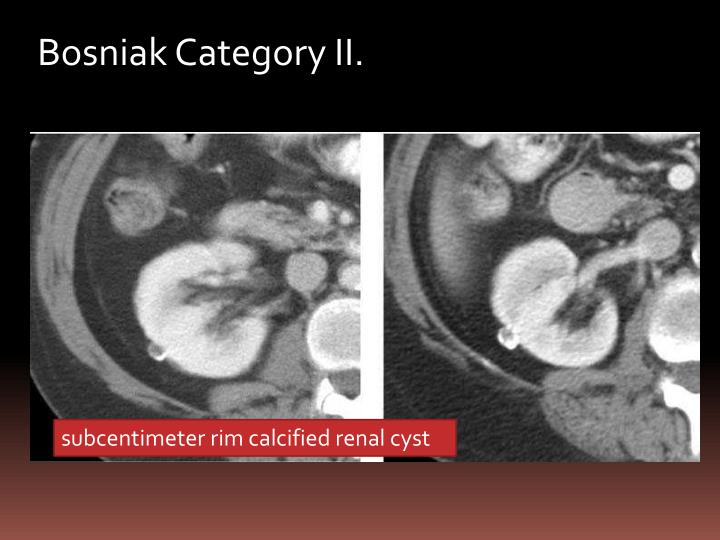 PPT - Simple and Complex renal Cysts PowerPoint Presentation - ID:363278