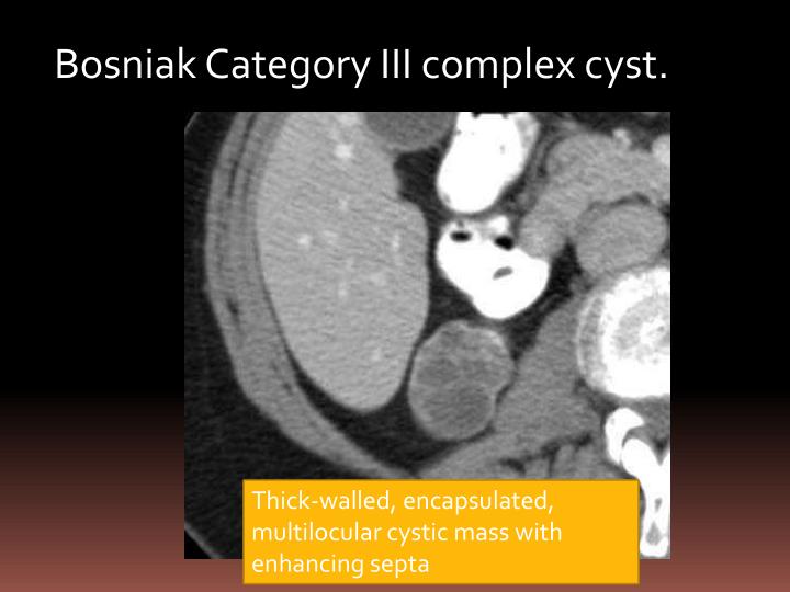 PPT - Simple and Complex renal Cysts PowerPoint Presentation - ID:363278