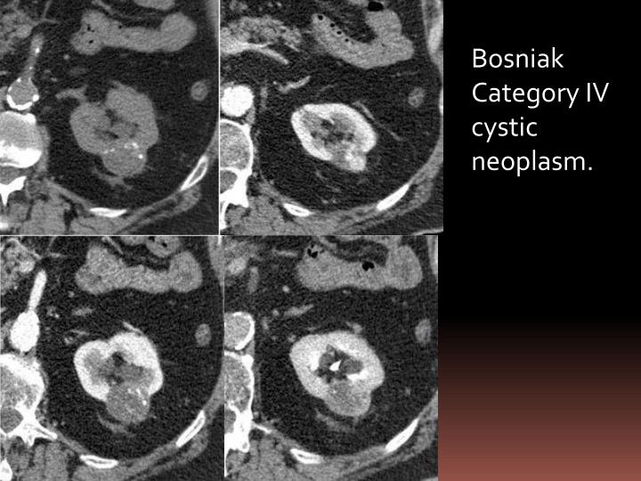 PPT - Simple and Complex renal Cysts PowerPoint Presentation - ID:363278