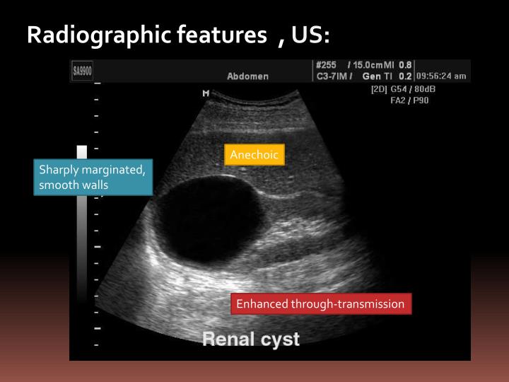 PPT - Simple and Complex renal Cysts PowerPoint Presentation - ID:363278