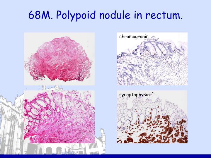 PPT - Special polyp types PowerPoint Presentation - ID:364945