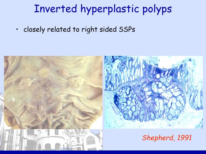 PPT - Special polyp types PowerPoint Presentation - ID:364945