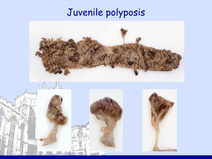 PPT - Special polyp types PowerPoint Presentation - ID:364945