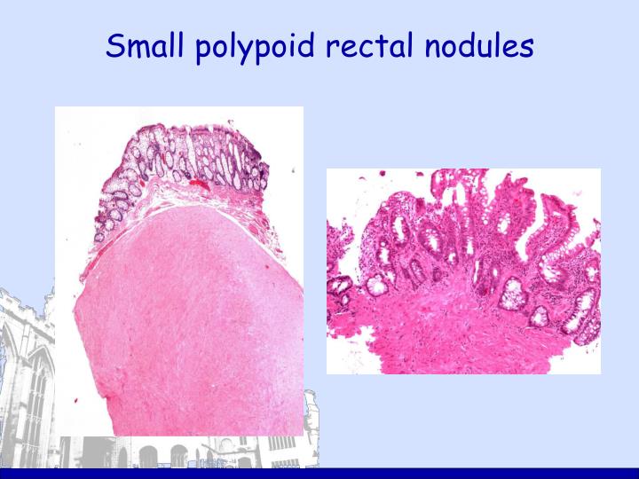 PPT - Special polyp types PowerPoint Presentation - ID:364945