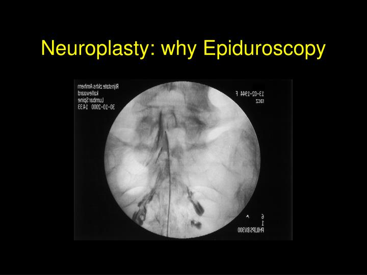 PPT - Epiduroscopy in the 21 th Century: State of the art PowerPoint ...