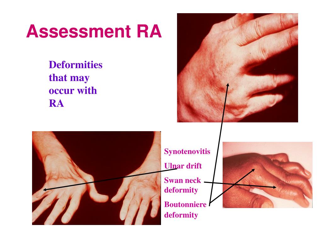 PPT - Musculoskeletal: Autoimmune; Inflammatory; Metabolic; Infectious ...