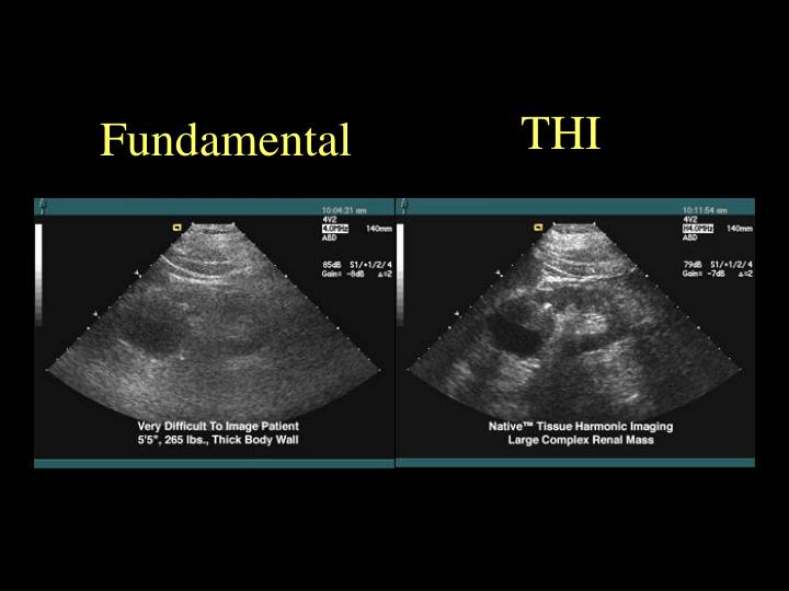 PPT - Ultrasonic Nonlinear Imaging- Tissue Harmonic Imaging PowerPoint ...