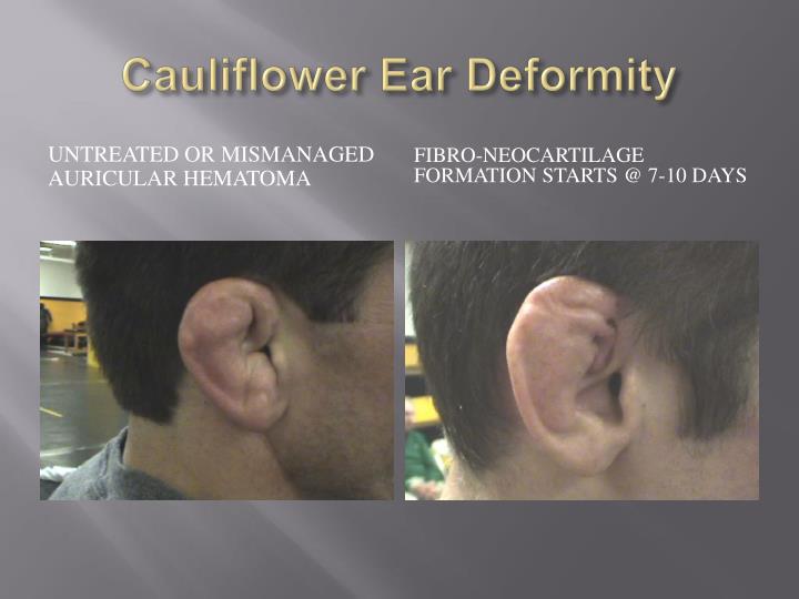 PPT - Management of Auricular Hematoma PowerPoint Presentation - ID:372352