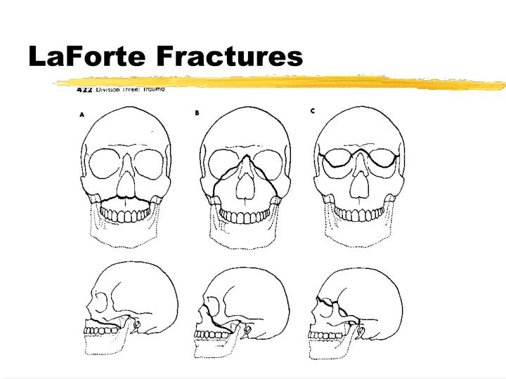 PPT - Head, Neck, & Spinal Trauma PowerPoint Presentation - ID:372630