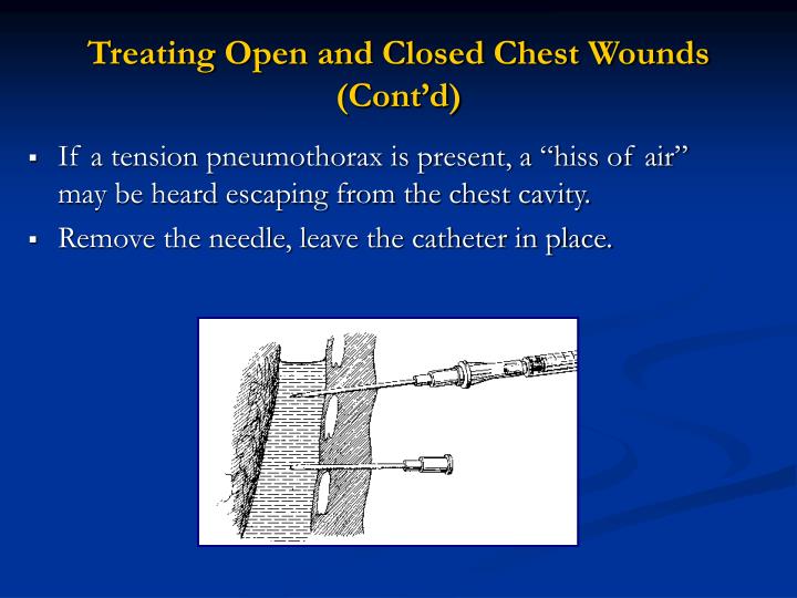 PPT - Treating Open and Closed Chest Wounds PowerPoint Presentation ...