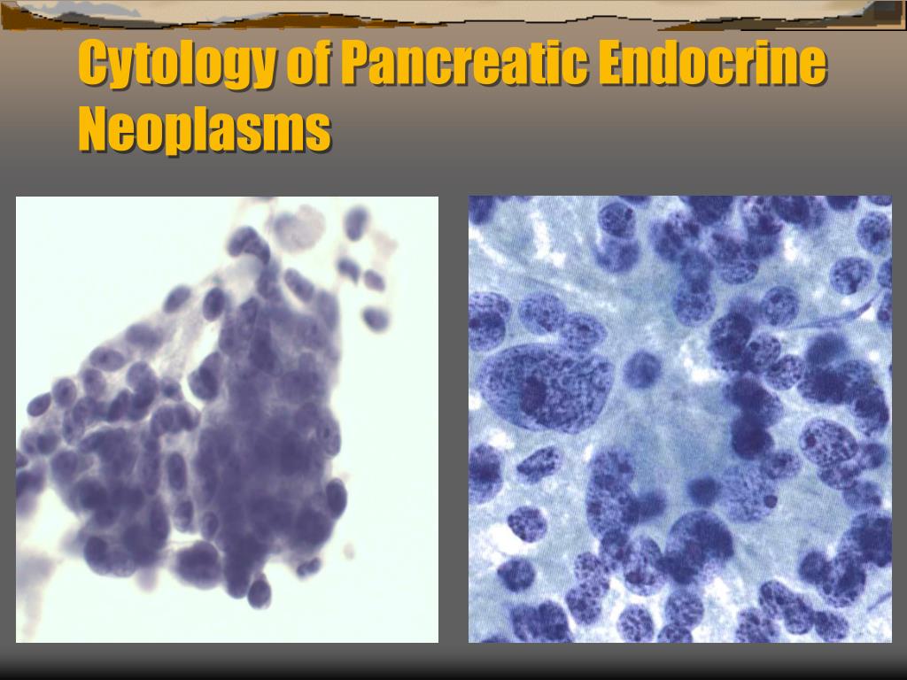 Ppt Fna Of The Pancreas Powerpoint Presentation Free Download Id
